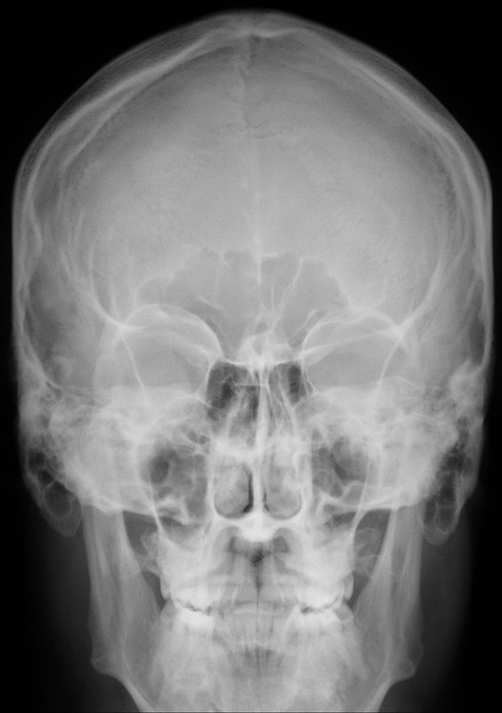 Maxillofacial Trauma - Dr Susan Kok
